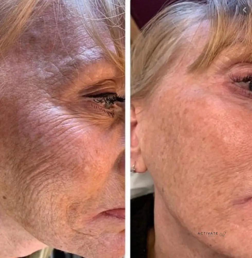 Mesobotox Treatment Near Queensville – Smooth Fine Lines with Precision ...